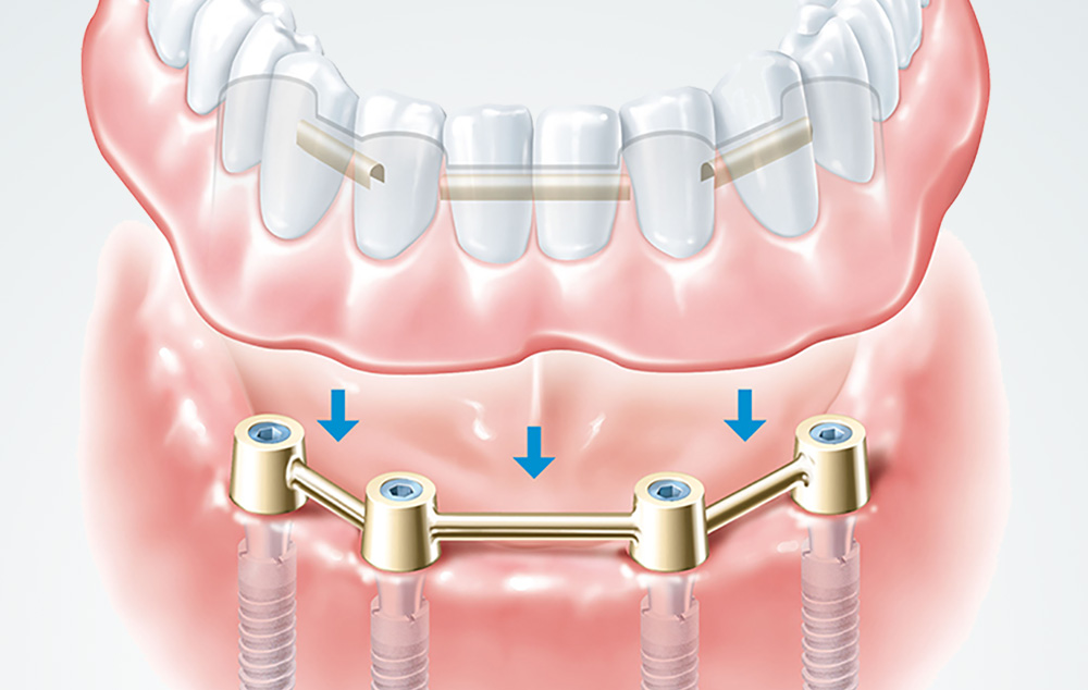 Fabricante de Sobredentaduras :: Laboratorio CDCLAM